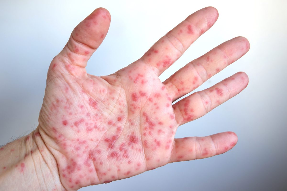 Duke tiene más de 60 casos de enfermedad de manos, pies y boca - La Noticia